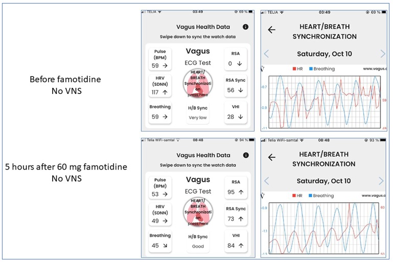 Case Study - Findings about the VAGUS test - BREATHE FLOW - Free health ...